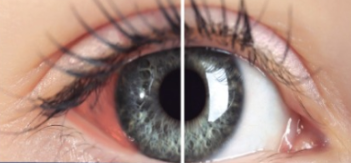 Ambliopía | Clinica De Los Ojos